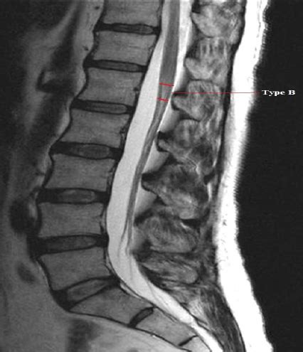 T2 Weighted Sagittal Mri Showing Spinal Cord Conus Medullaris Position