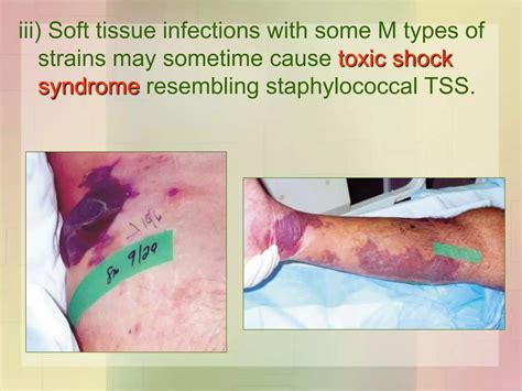 Streptococcus And Enterococcus By Dr Rakesh Prasad Sah Pptx Streptococcus And Enterococcus By Dr Rakesh Prasad Sah Pptx