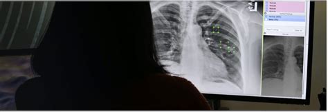 Fda Clears Ai Powered Software For Lung Nodule Detection On X Rays