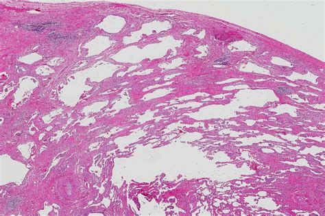 50 Facts About Idiopathic Diffuse Interstitial Fibrosis