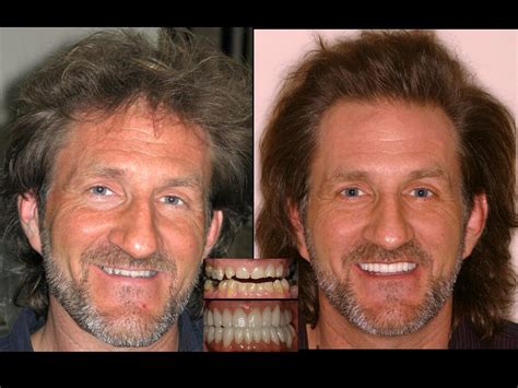 Dental Implant Before And After Photos