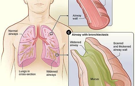 Bronchiectasis Is A Stretched And Dilated Condition Of The Small