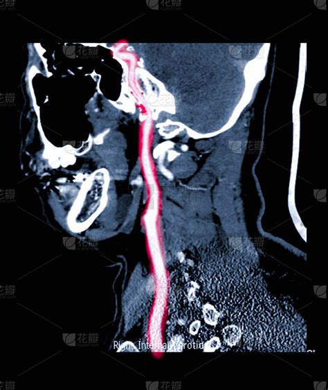 Cta脑3d图像，2d冠状面显示右侧颈总动脉。