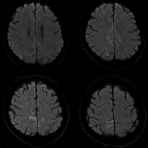 Mri Scan At Admission Axial Diffusion Weighted Sequence Showing