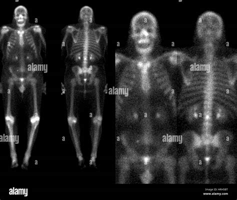 Abnormal Bone Scan Hi Res Stock Photography And Images Alamy