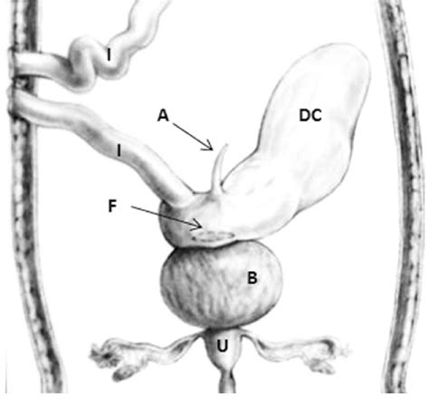 Anatomy Of One Patient With Cloacal Exstrophy Variant Covered Cloacal
