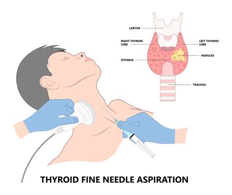 Beyond The Biopsy Revolutionizing Thyroid Nodule Evaluation Suzy