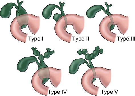 Mirizzi Syndrome Causes Types Symptoms Diagnosis Treatment And Prognosis