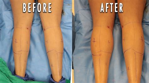 Calf Implants For Skinny Legs