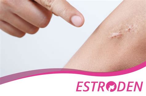 Skin Avulsion Causes Symptoms And Treatment Options Estroden