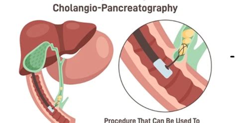 Ercp Procedure For Pancreatic And Bile Duct Conditions Adventhealth Tampa