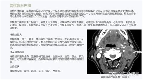 图扁桃体详细解剖分享 知乎