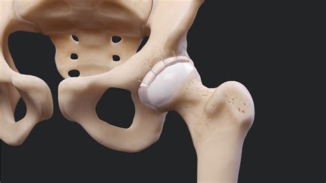 Arthrex Acetabular Labral Reconstruction Using Precinched Loops From Knotless Hip Fibertak