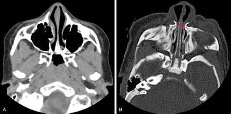Choanal Atresia Pyriform Aperture Stenosis Clinical Tree