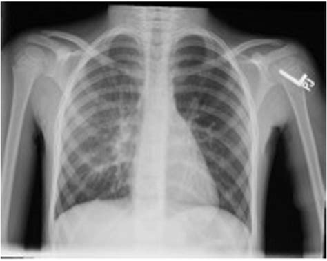 Chest X Ray Demonstrating Hyperlucency Confirming Swyer James Macleod