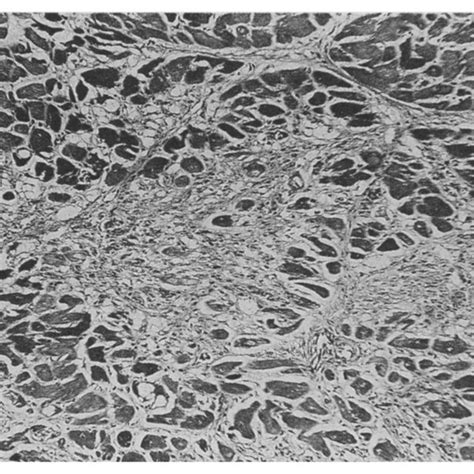 Interstitial Inflammation Including Mononuclear Cell Infiltration