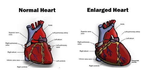 Enlarged Heart Cardiomegaly And Heart Failure Everyday Heart Failure