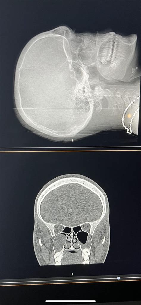 Post Sinus Surgery Rsinusitis