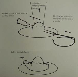 Usefulness Of The Nipple Suspension Piercing Device After Correction Of