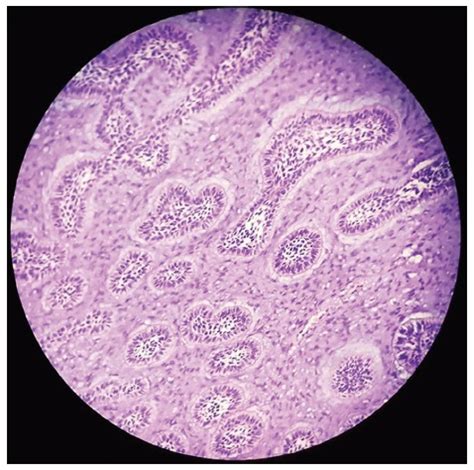 Odontoma Histology