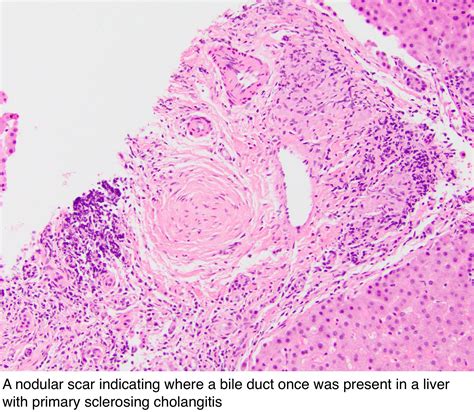 Pathology Outlines Primary Sclerosing Cholangitis