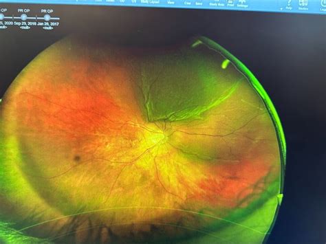 Brian Tompkins On Linkedin Eyecare Wecare Optomap Oct Retinalexamination Careplan…