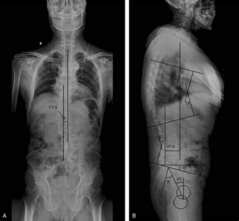 Risk Factors Of Degenerative Lumbar Scoliosis In Patients Wi Medicine