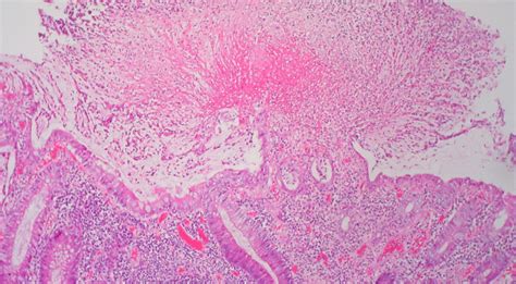 On Biology Could Fecal Transplants Be The Way Forward For Treating C