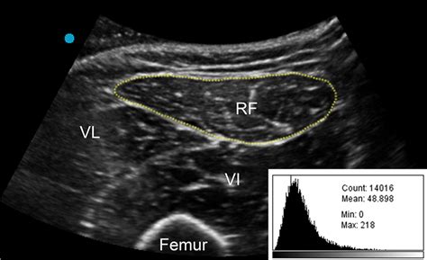 Representative Ultrasound Image Of A Relaxed Rectus Femoris Rectus Download Scientific Diagram