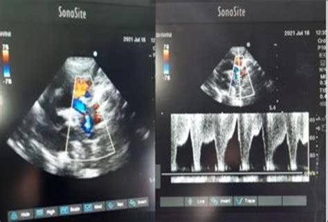 Suprasternal View On Echo S O All 4 Pulmonary Veins Draining Via