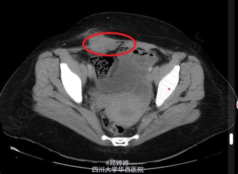 腹前壁子宫内膜异位症一例 医联