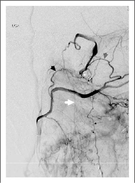 Figure 4 From Transarterial Onyx Embolization Of Jugular Foramen Dural Arteriovenous Fistula