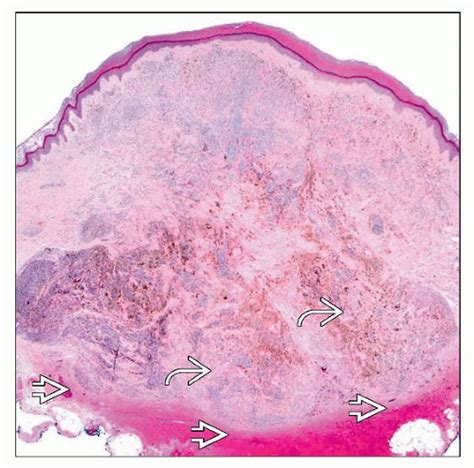 Blue Nevus Histology