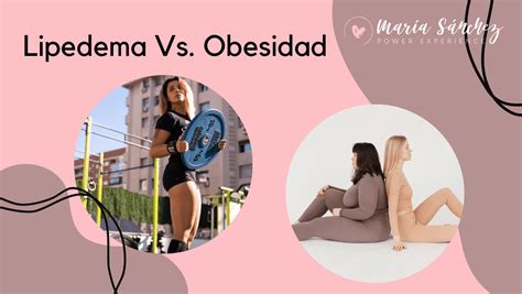 Lipedema Vs Obesidad María Sánchez Personal Trainer Power Experience