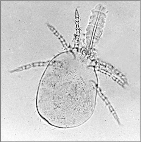 Chiggers Dermatology Medbullets Step 1