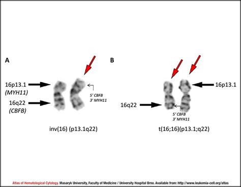 Acute Myeloid Leukaemia With Inv 16 P131q22 Or T 16 16 P13 1 Q22 Cbfb Myh11 Cell