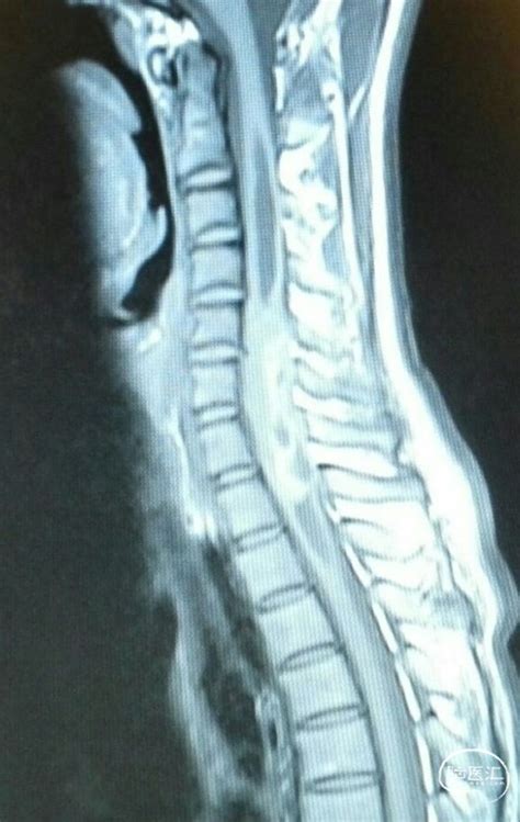 浙江省人民医院神经外科团队：脊髓毛细胞型星形细胞瘤（1例） 脑医汇