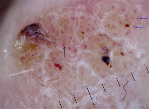 The Cunliffe Tp Clinicodermoscopic Skin Lesion Tool