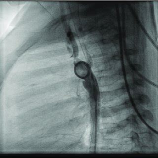 Short Axis View Echocardiogram Showed The Size Of The PDA Download Scientific Diagram