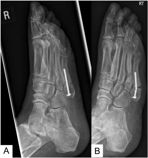 Pseudo Jones Fracture