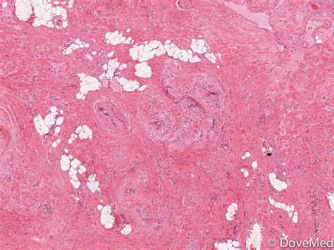 Angiomyolipoma Of Vagina