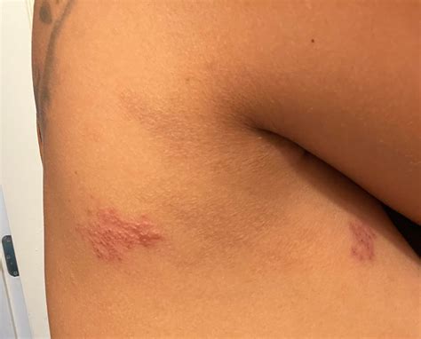 It Seems My Shingles Have Returned Ans Now On The Other Side Anyone