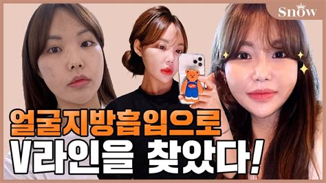 성형 브이로그 2탄 얼굴지방흡입으로 V라인을 찾았다 Youtube