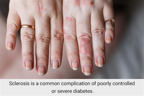 Diabetes Skin Problems Pictures