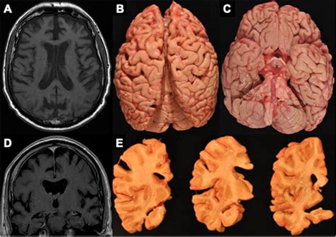 Cte Brain