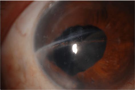 Slit Lamp Image Showing The Linear Horizontal Corneal Scar That Formed
