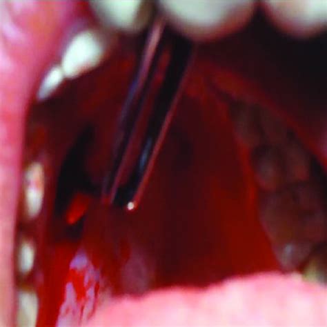 Subepithelial Connective Tissue Graft Harvested From Palate Download
