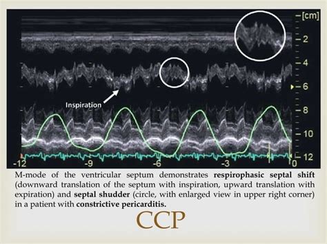 Hemodyanmic Features Of Constrictive Pericarditis And Restrictive