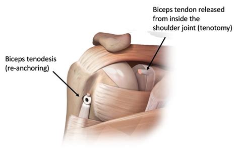 Rotator Cuff Repair With Biceps Tenodesis Protocol Clinicspots