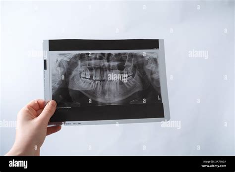 Dental X Ray Diagnostics Help Identify Hidden Tooth Problems And Ensure
